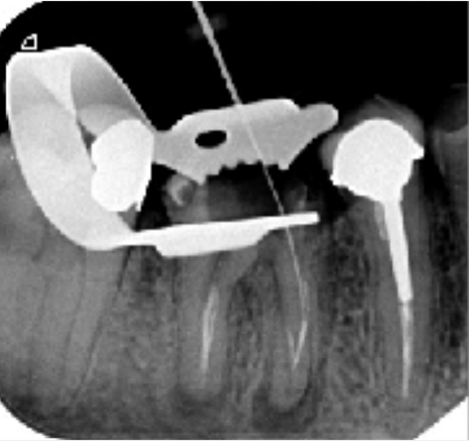 FANTA Limes Endo - Séquence Retraitement