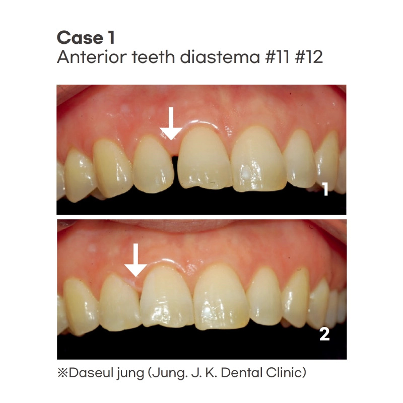 SPIDENT- Composite antéropostérieur hybride ESCOM 250