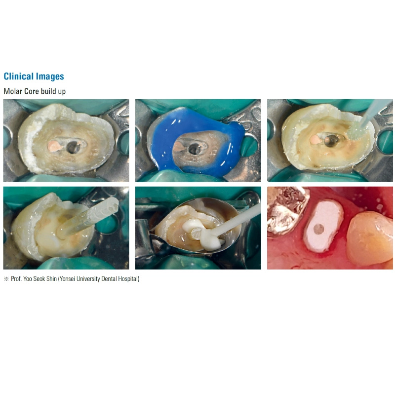 SPIDENT - Core.it Flowable dual cured core build-up resin 2 x 10g ...