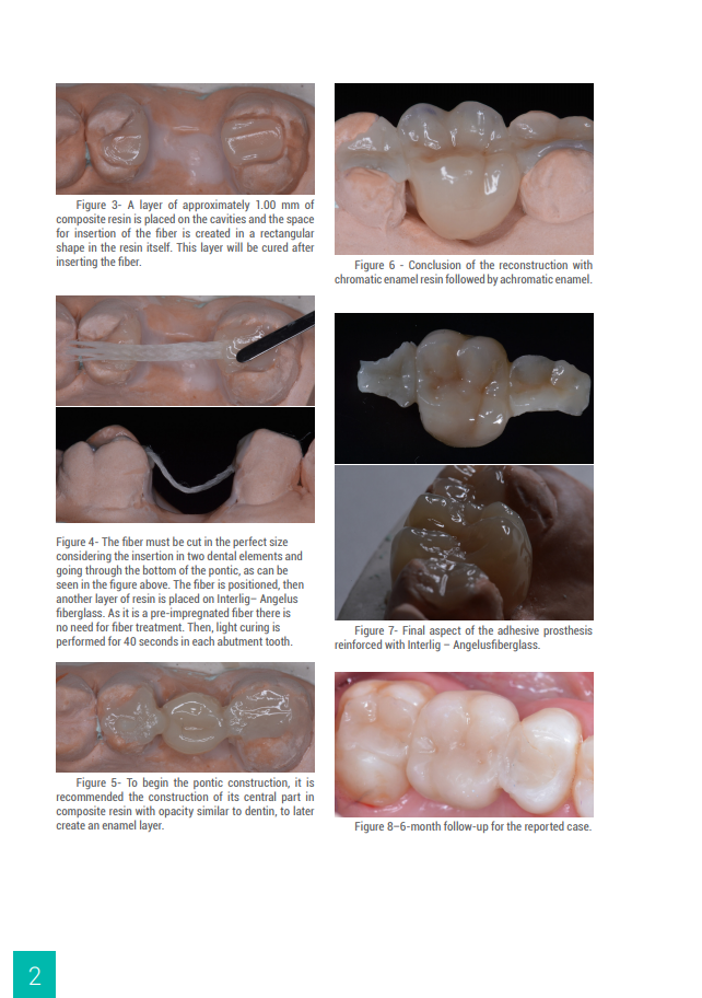 ANGELUS - Interlig - Bandes fibre de verre