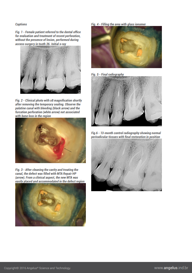 ANGELUS - MTA Repair HP Conditionnement 2 capsules